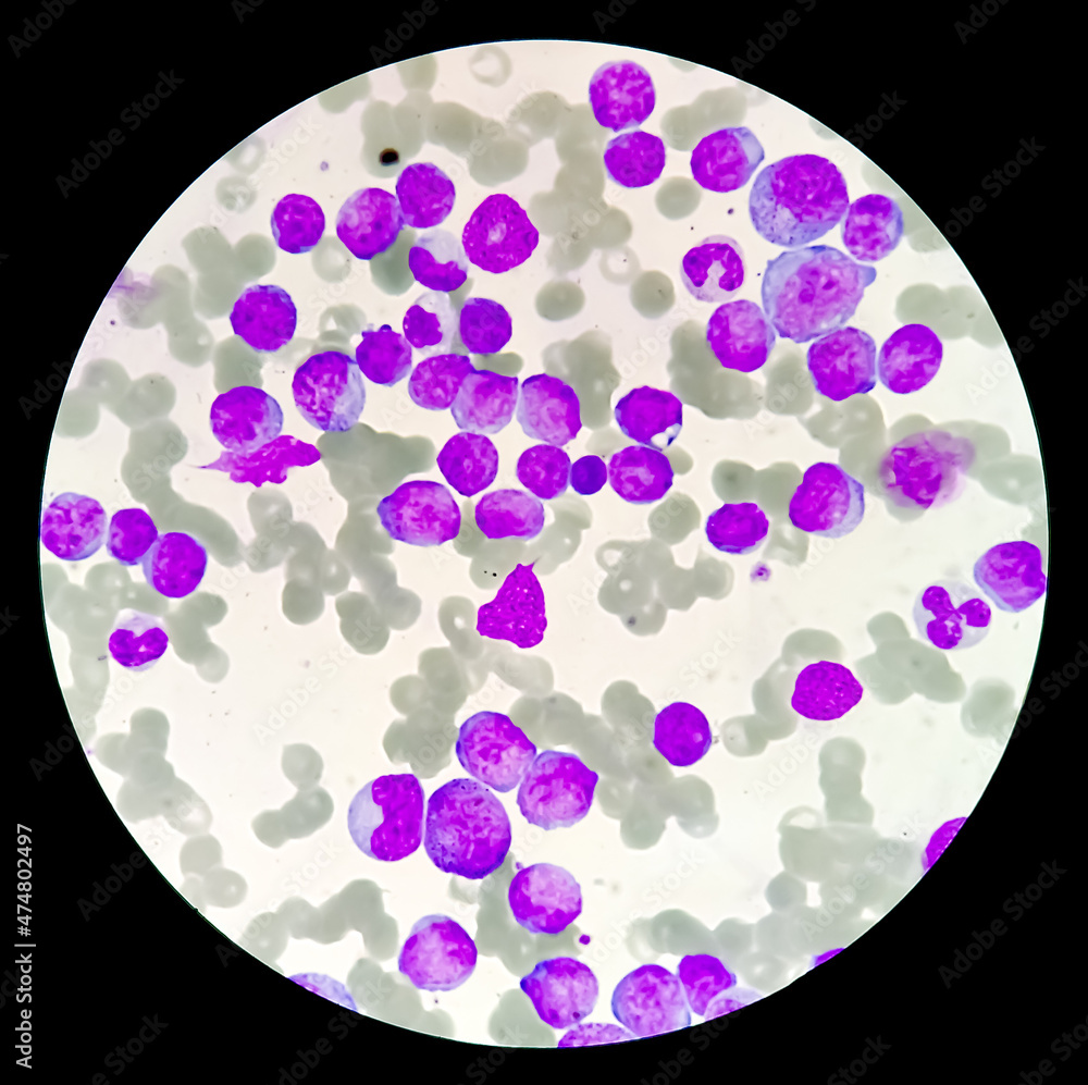 Photomicrograph of Acute Myeloblastic Leukemia (AML), a cancer of white ...