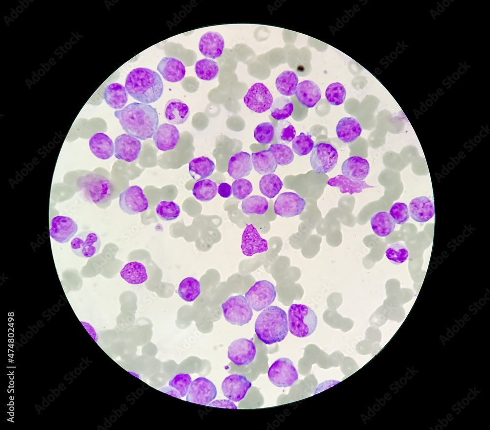 Acute myeloid leukemia (AML) is a type of blood cancer. Microscopic ...