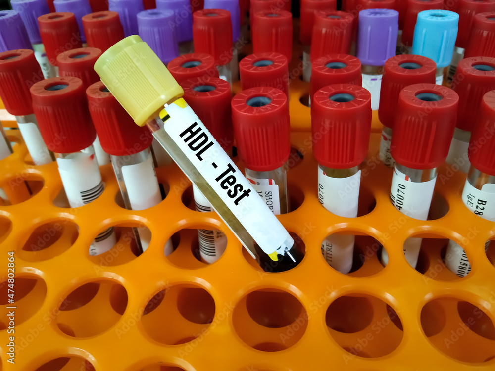 Blood sample for HDL Cholesterol test, HDL-C, good cholesterol Stock ...