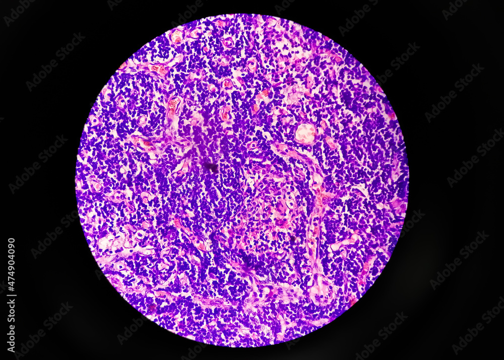 Breast Cancer Awareness: Microscopic image (photomicrograph) showing ...