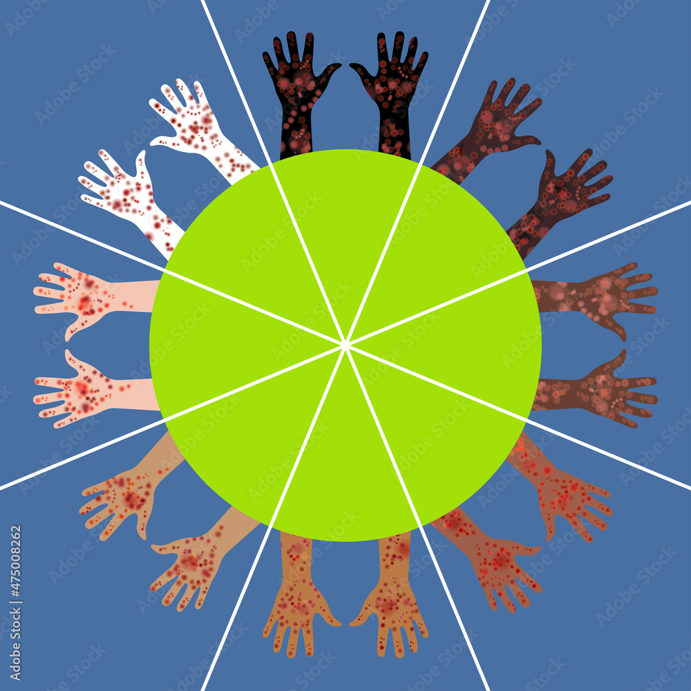8 different skin colors of hands pairs. Palms up around circle. Painful ...