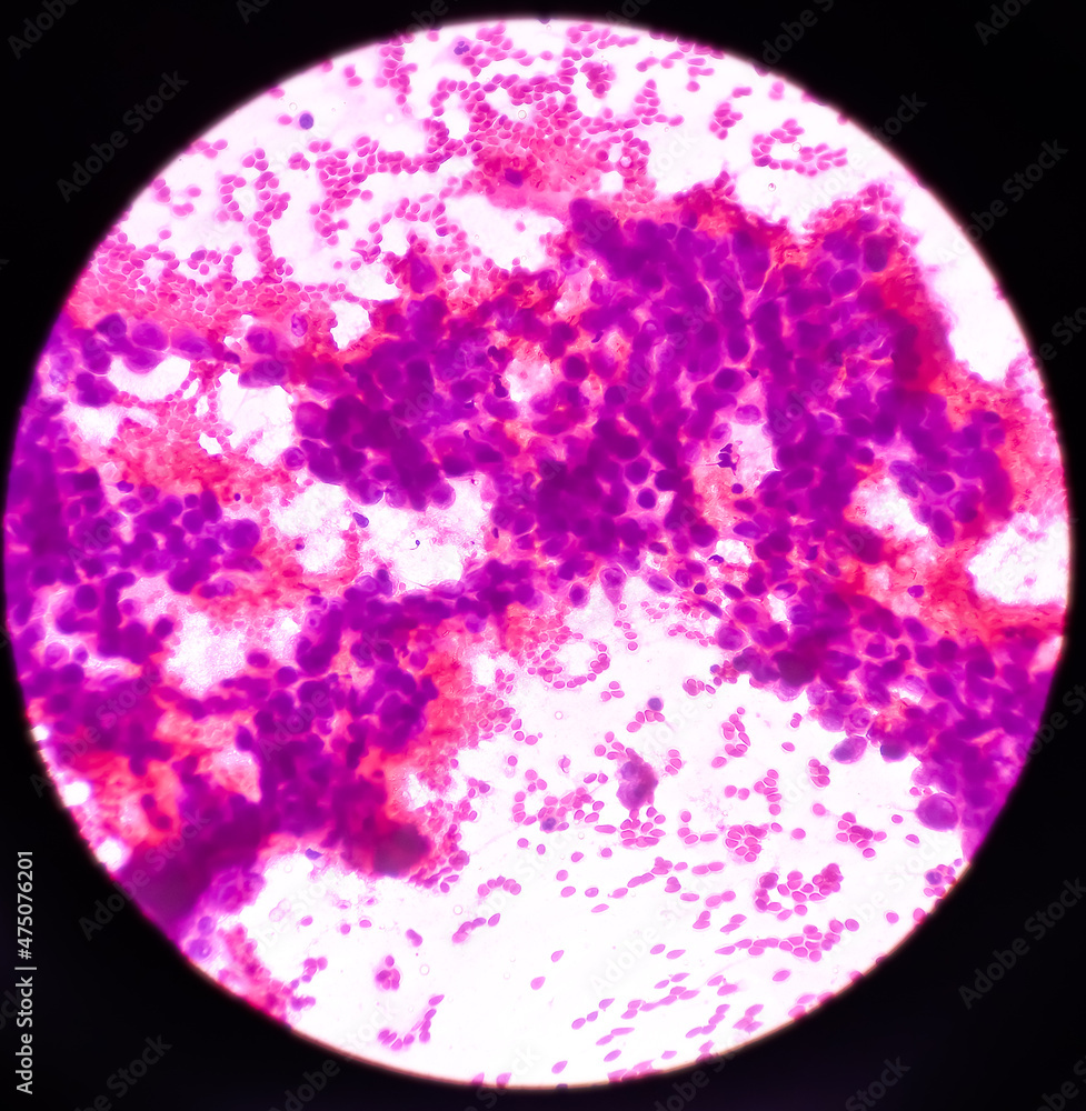 Parotid swelling, malignant cell consistent with mucoepidermoid ...