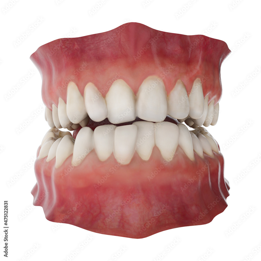 Jaw with abnormal teeth position. Orthodontic treatment concept ...