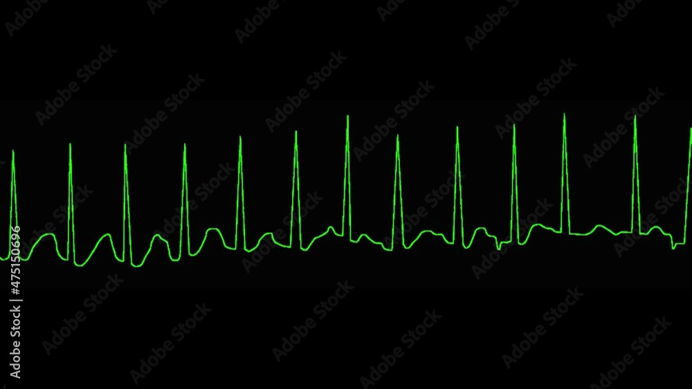 ecg arrhythmia animation multifocal atrial tachycardia (MAT) Stock 비디오 ...