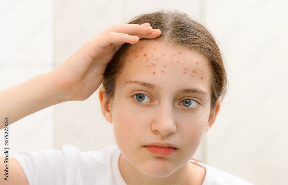 portrait of a teenage girl touches her face with pimples, acne on the ...