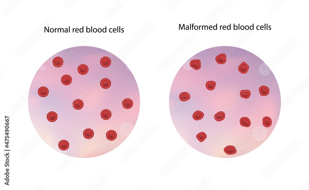Normal and malformed red blood cells, illustration Stock Illustration ...