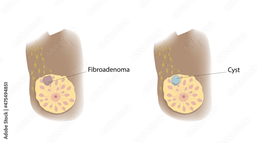 Fibroadenoma and cyst comparison, illustration Stock Illustration ...