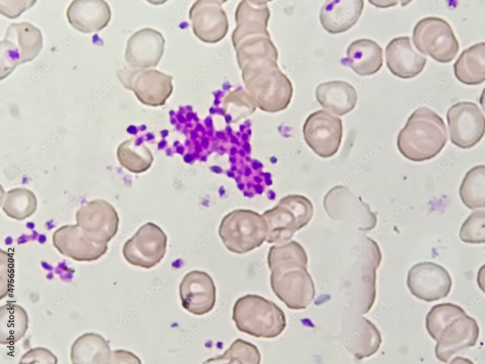 Giant platelet disorders are rare disorders featuring abnormally large ...