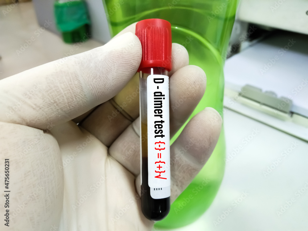 Test tube with positive blood sample for D-dimer test, diagnosis for ...
