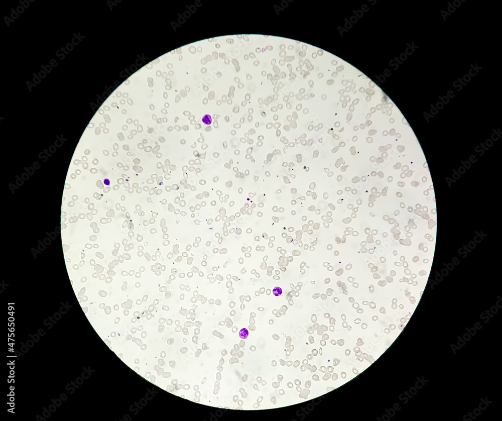 Dimorphic anemia analyzed by microscope. It is also called iron ...