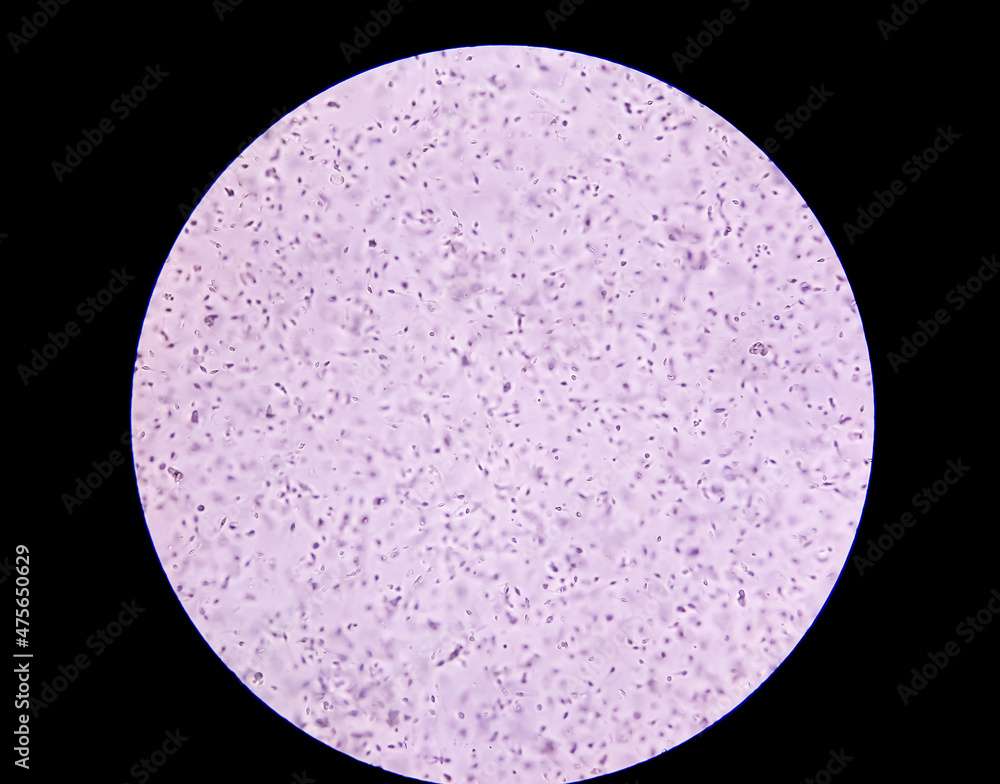 Sperm morphology. Semen photo under microscope. Micrograph showing ...