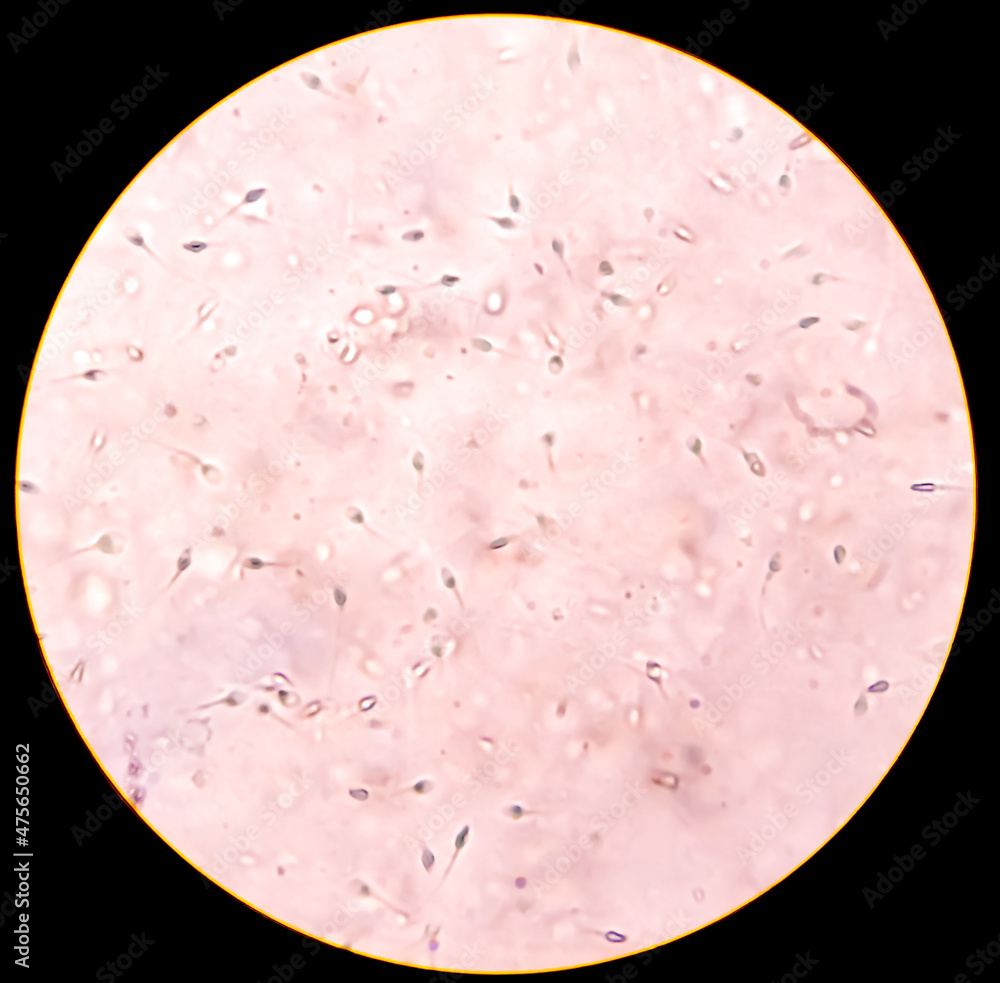 Sperm morphology. Semen photo under microscope. Micrograph showing ...