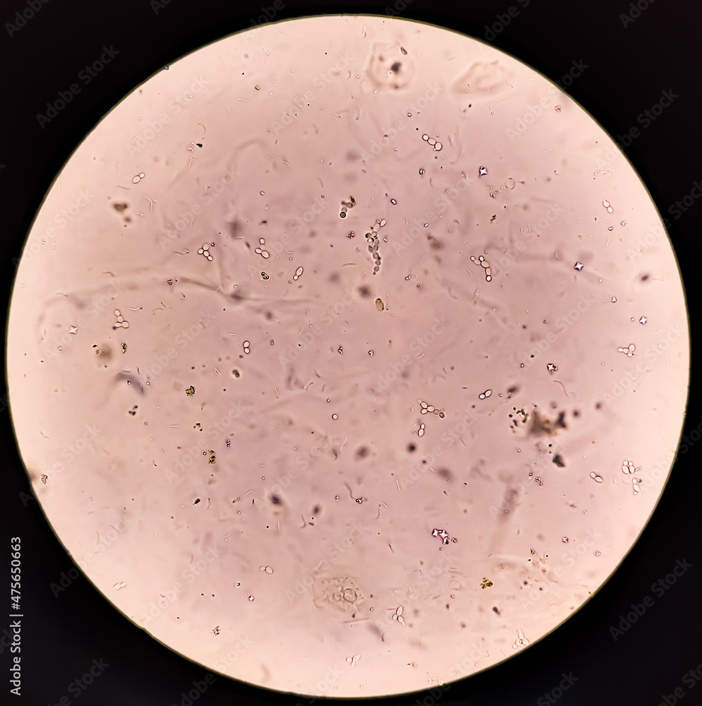 Sperm morphology. Semen photo under microscope. Micrograph showing ...