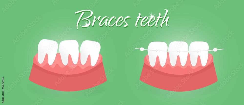 Braces teeth.Dental concept.flat vector illustration of the rules for ...