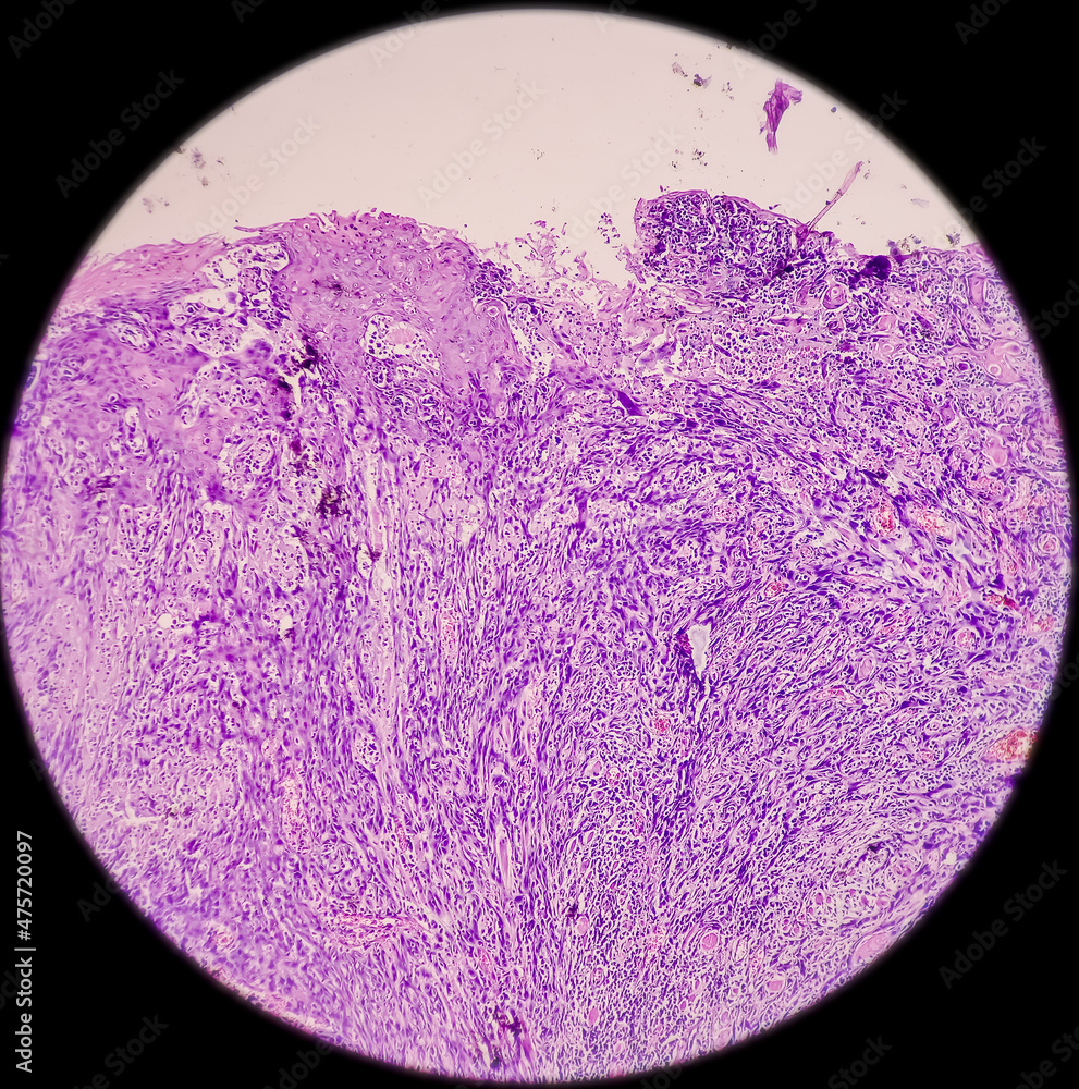 Tongue with mandible cancer, oral cancer, Invasive squamous cell ...