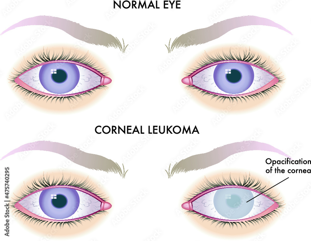 Medical illustration of one of the possible consequences of corneal ...