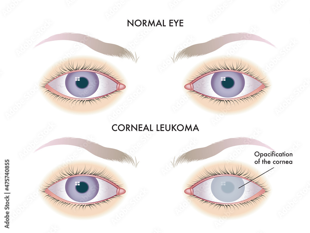 Medical illustration of one of the possible consequences of corneal ...