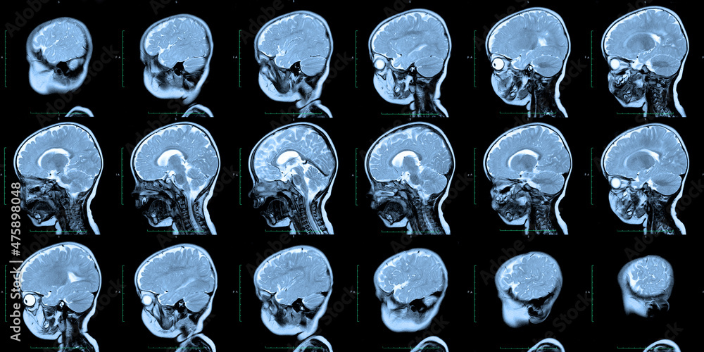 MRI scan of the human skull and brain, with malformations of the brain ...