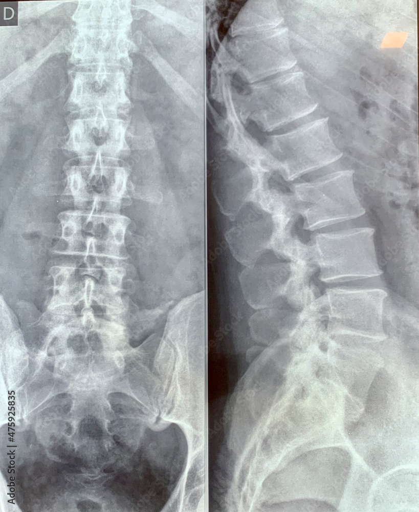 radiografía de la columna vertebral Stock Photo | Adobe Stock