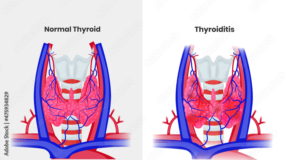 Normal thyroid anatomy vs thyroiditis. Illustration of the normal thyroid structure and inflamed ...