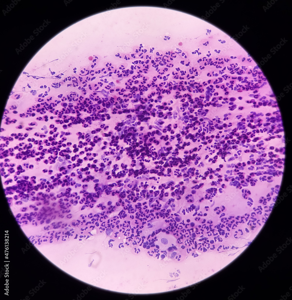 Foto de Conventional pap's smear: Reactive cellular changes associated ...