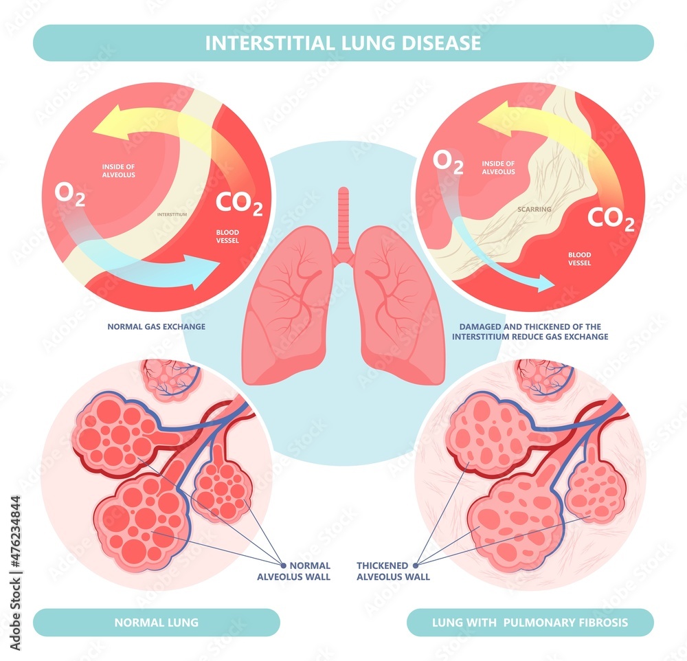 Capillary dry cough of wood metal dust breath virus Chest X-ray Cancer ...
