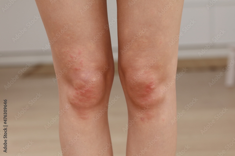 skin allergies, legs skin women. Closeup of red pustules on a knee, an ...