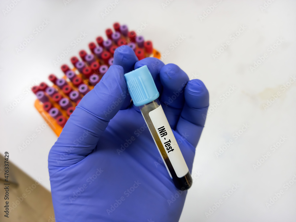 Blood sample for INR test(prothrombin time test), Blood coagulation ...