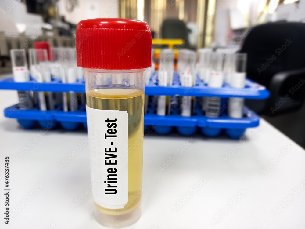 Urine specimen container with sample for Urine EVE test, laboratory ...