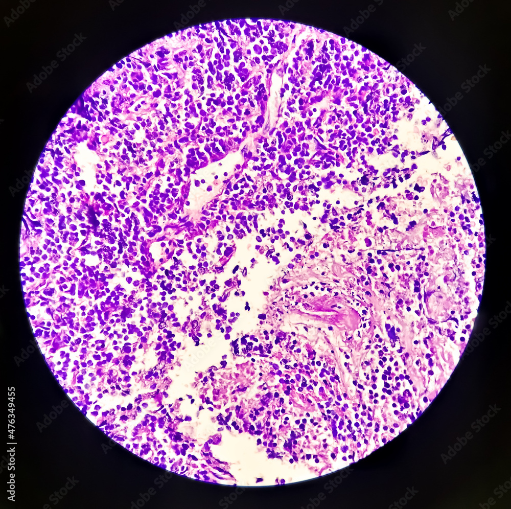 Leiomyoma, or fibroids, is a smooth muscle benign tumors, light ...