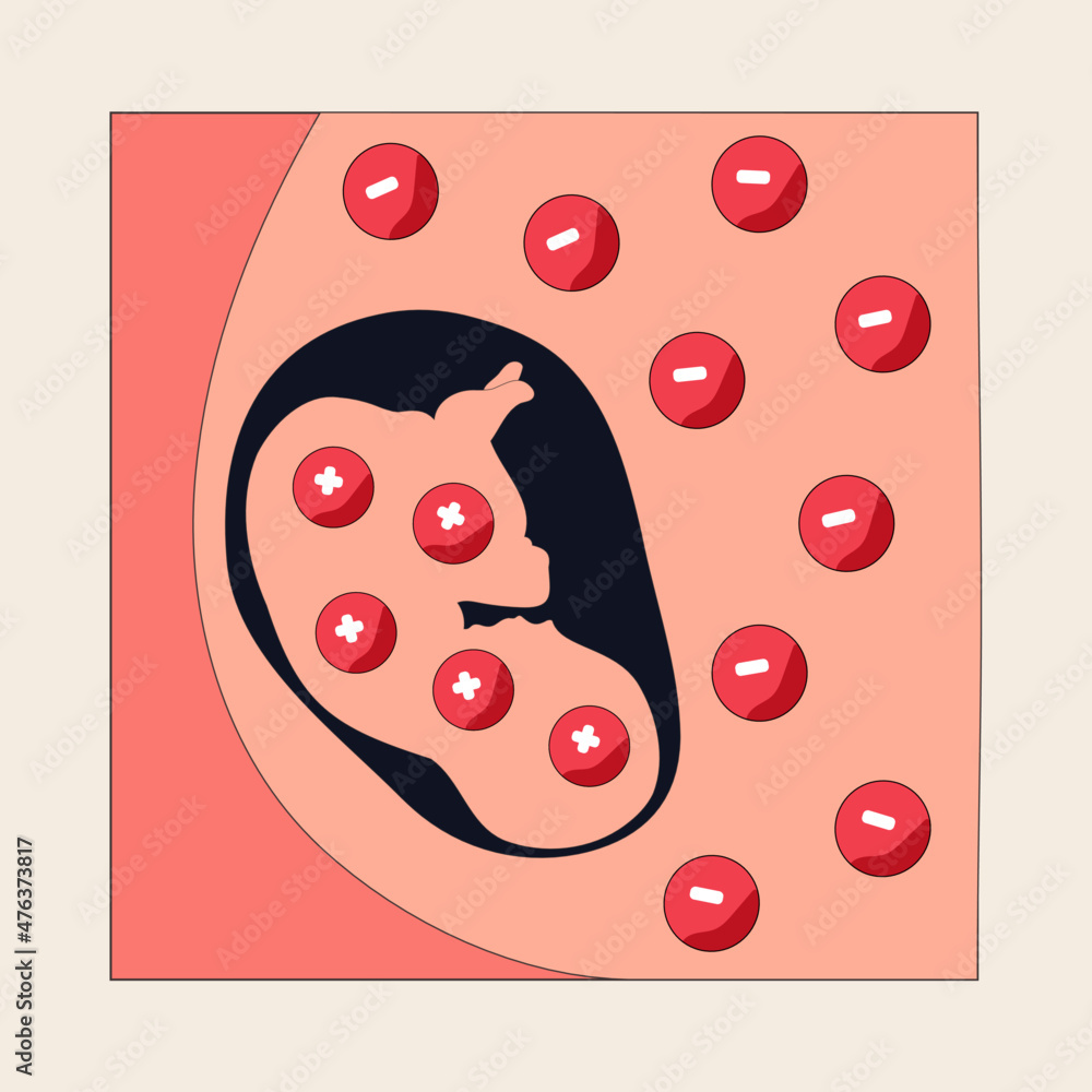 Hemolytic disease of the fetus and newborn Infographic. Vector illustration of Rh disease ...