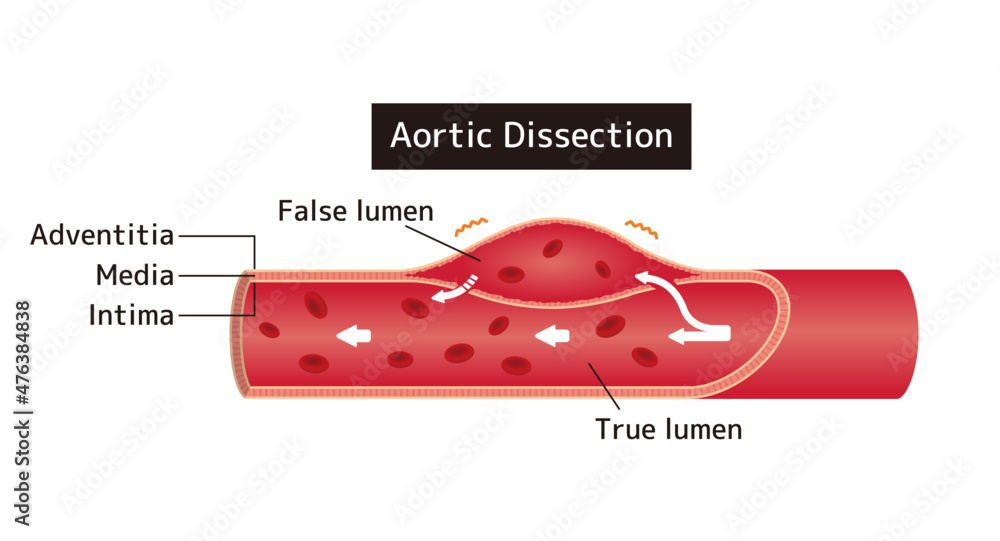Vector illustration of aortic dissection Stock Vector | Adobe Stock