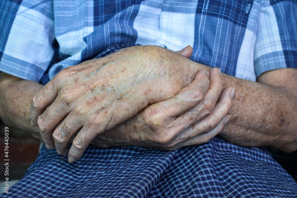 Fotografia Do Stock Age Spots On Hands They Are Brown Gray Or Black fotografia-do-stock-age-spots-on-hands-they-are-brown-gray-or-black