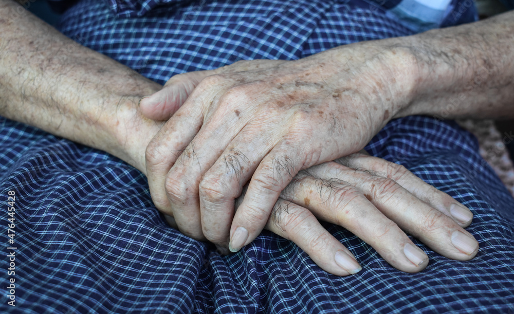 Age spots on hands. They are brown, gray, or black spots and also ...