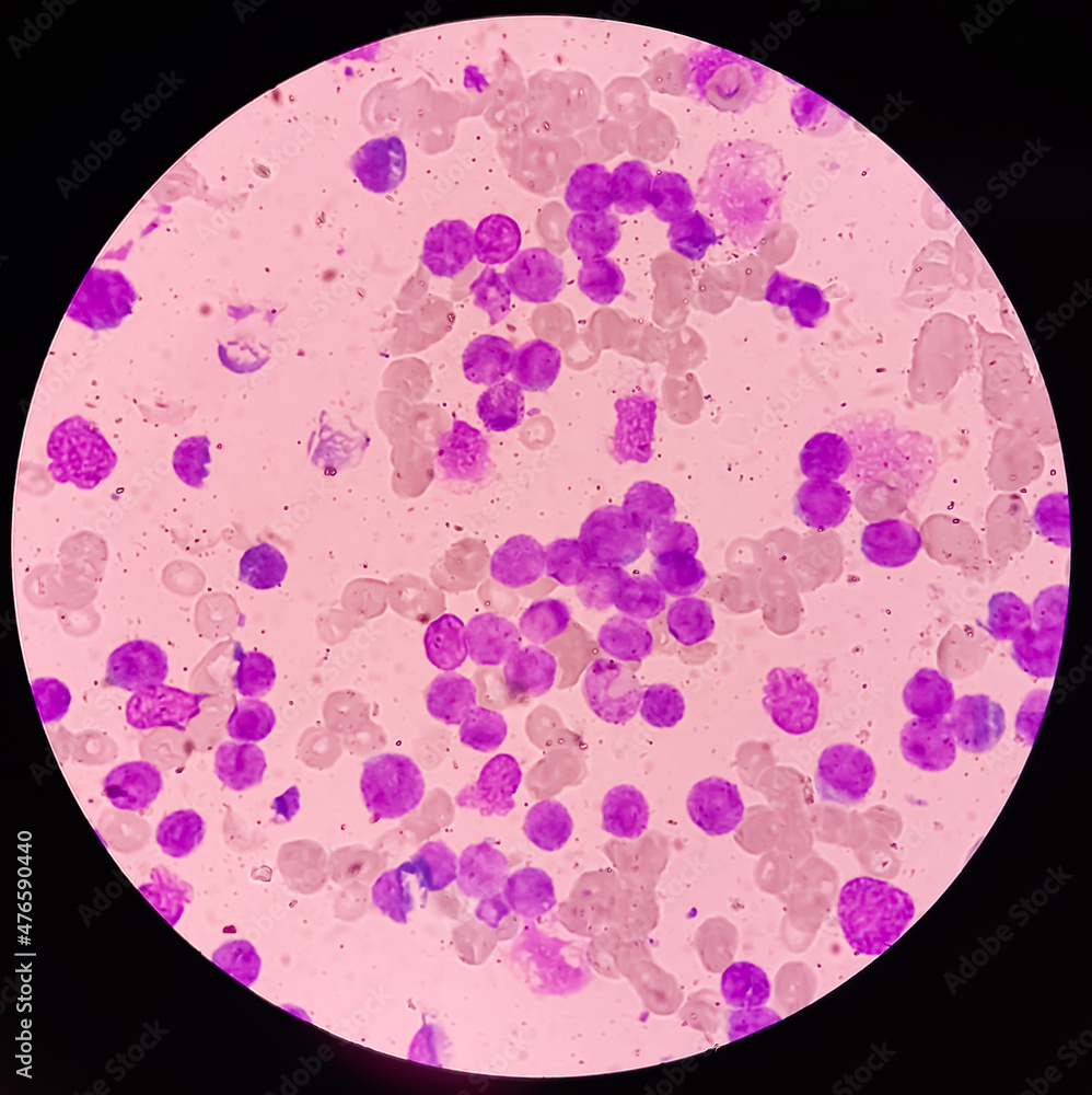 Chronic myeloid leukemia (CML) is a type of blood cancer. Microscopic ...