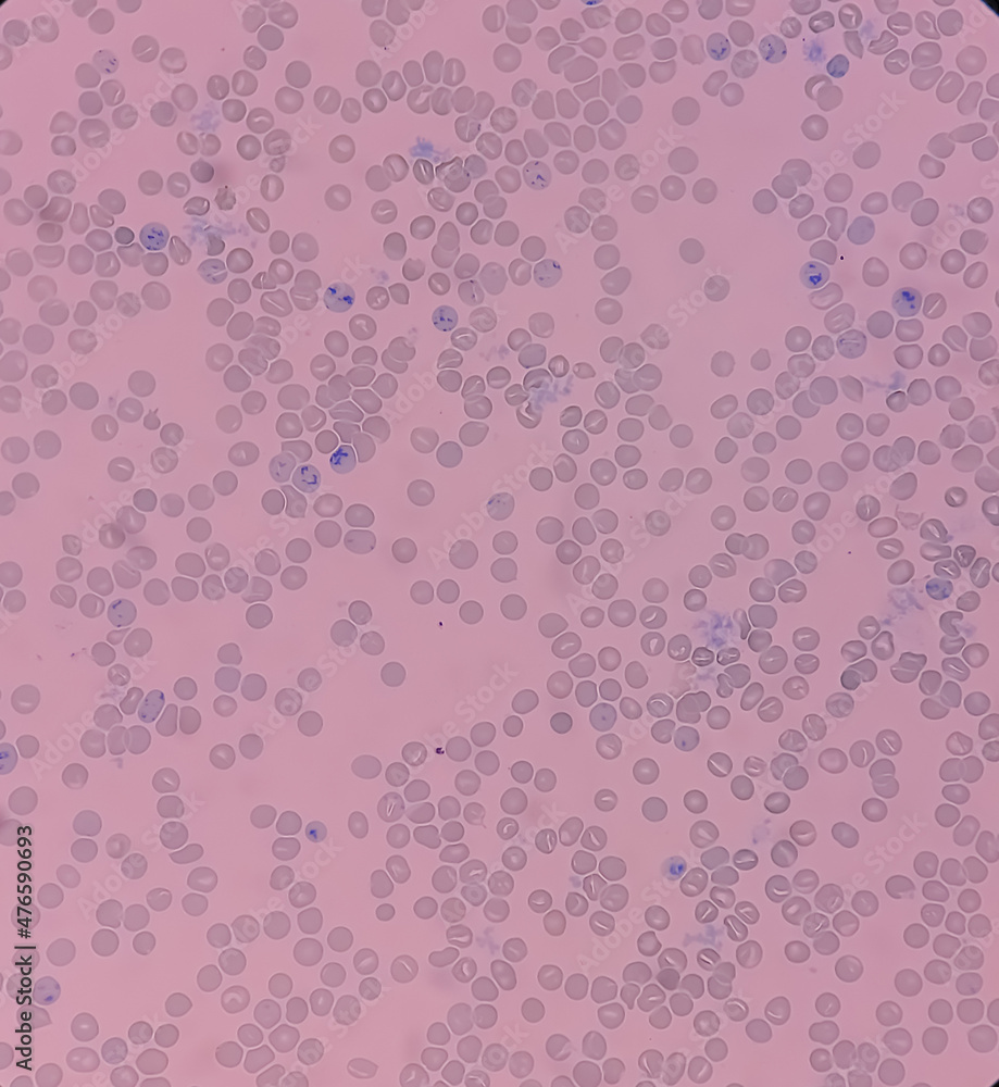 Reticulocyte count under microscope, 100x. methylene blue staining ...