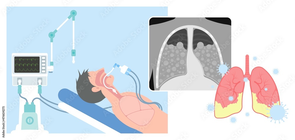 Acute respiratory distress syndrome (ARDS) a respiratory failure and ...