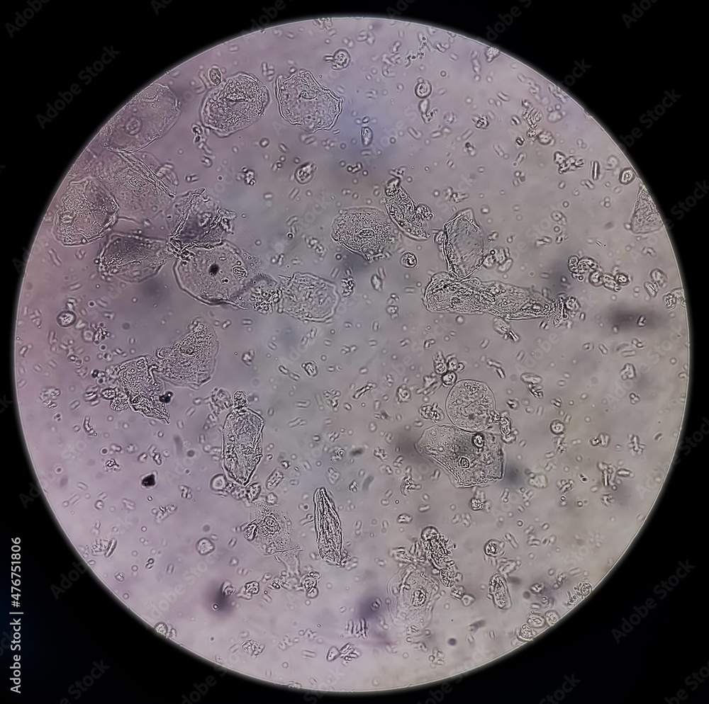 Epithelial cells with bacteria in patient urine (urinary tract ...