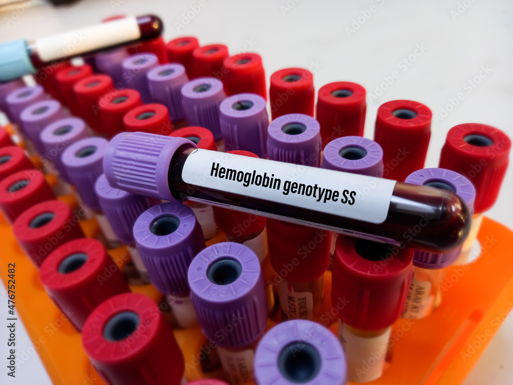 Blood sample tube with blood for Hemoglobin genotype SS-test ...