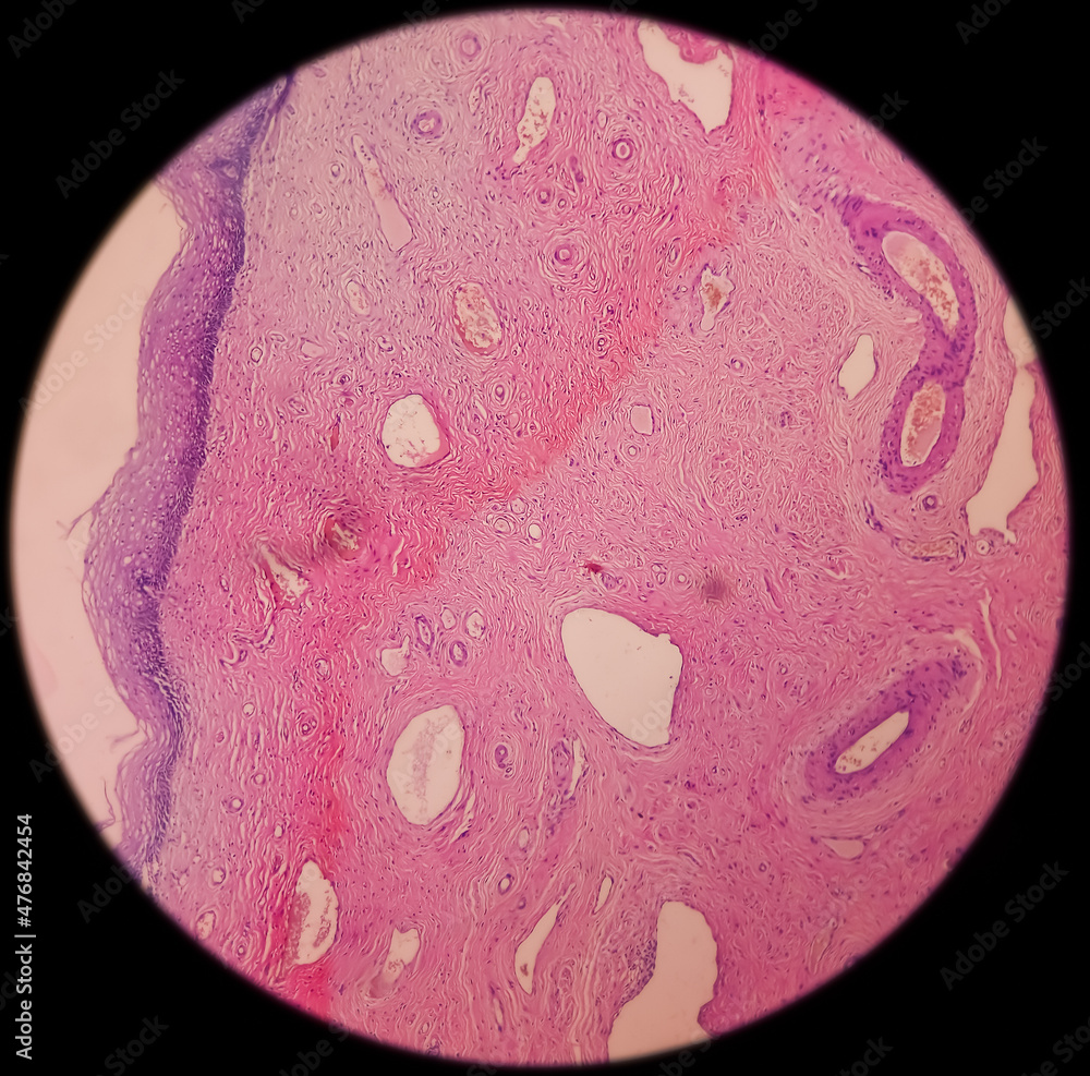 Chronic cervicitis with CIN-1, under light microscope show chronic ...