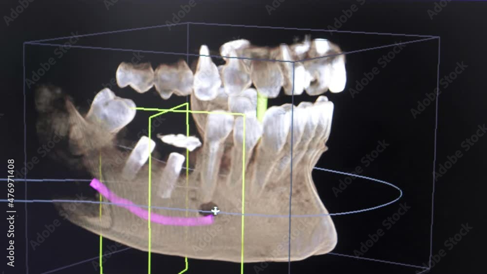 Close-up 3d model of X-ray images of the patient's jaw and teeth on the ...