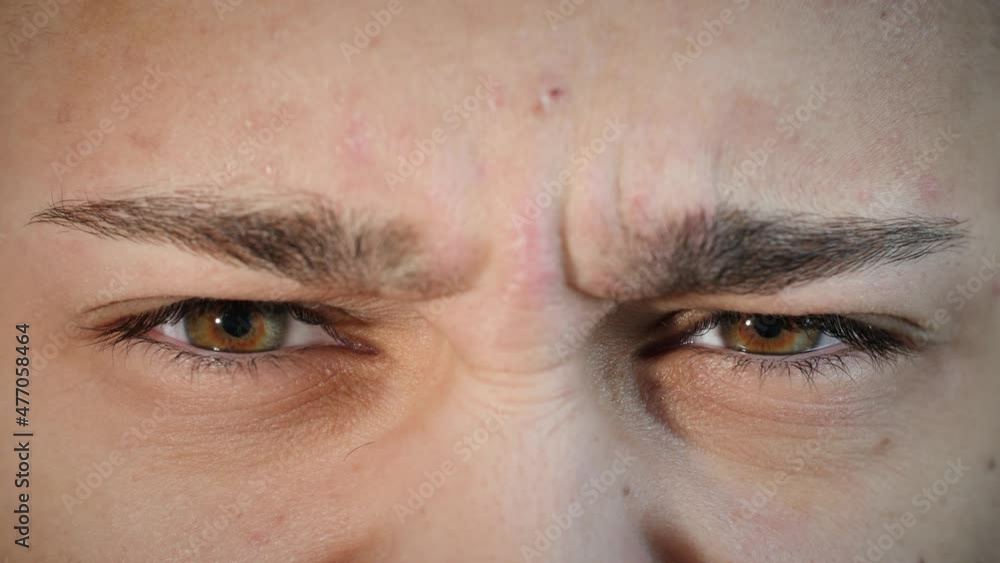 Macro close up of angry man's face with hazel eyes and acne skin ...