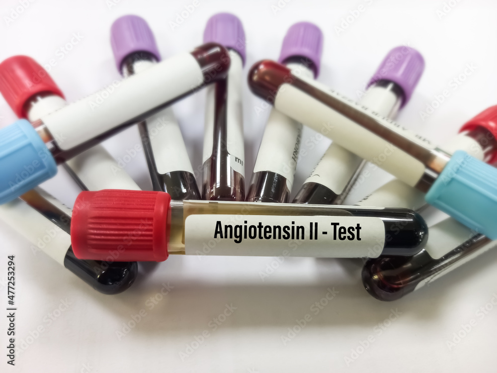 Blood sample for Angiotensin II test. To diagnosis and monitor ...