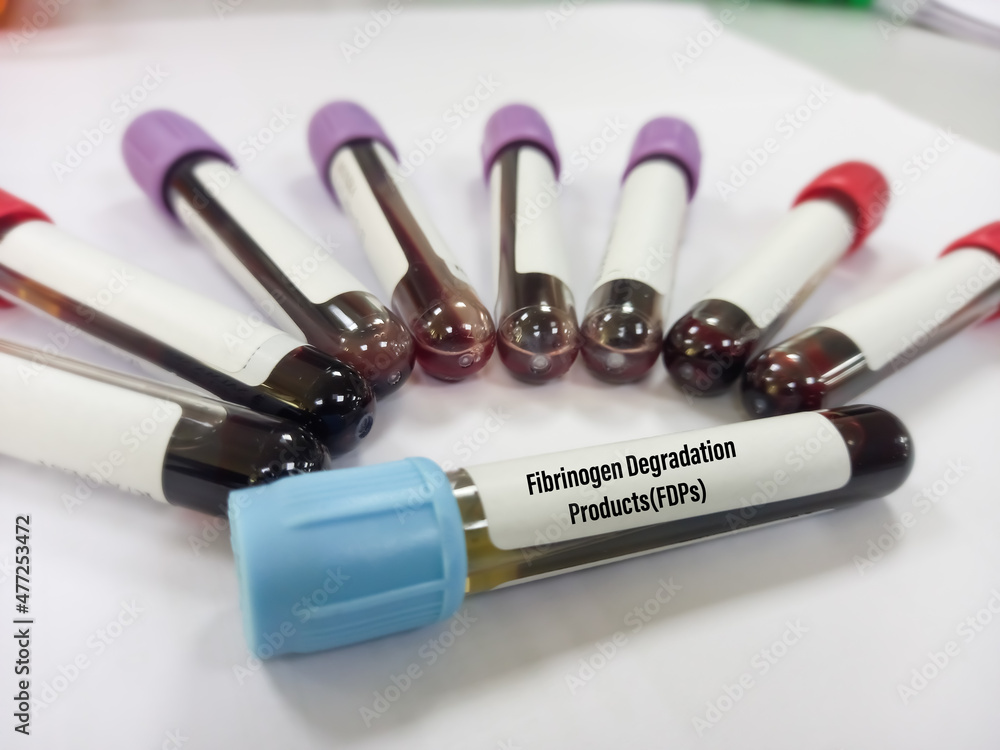 Blood sample for Fibrin degradation products (FDPs) test. To diagnosis ...