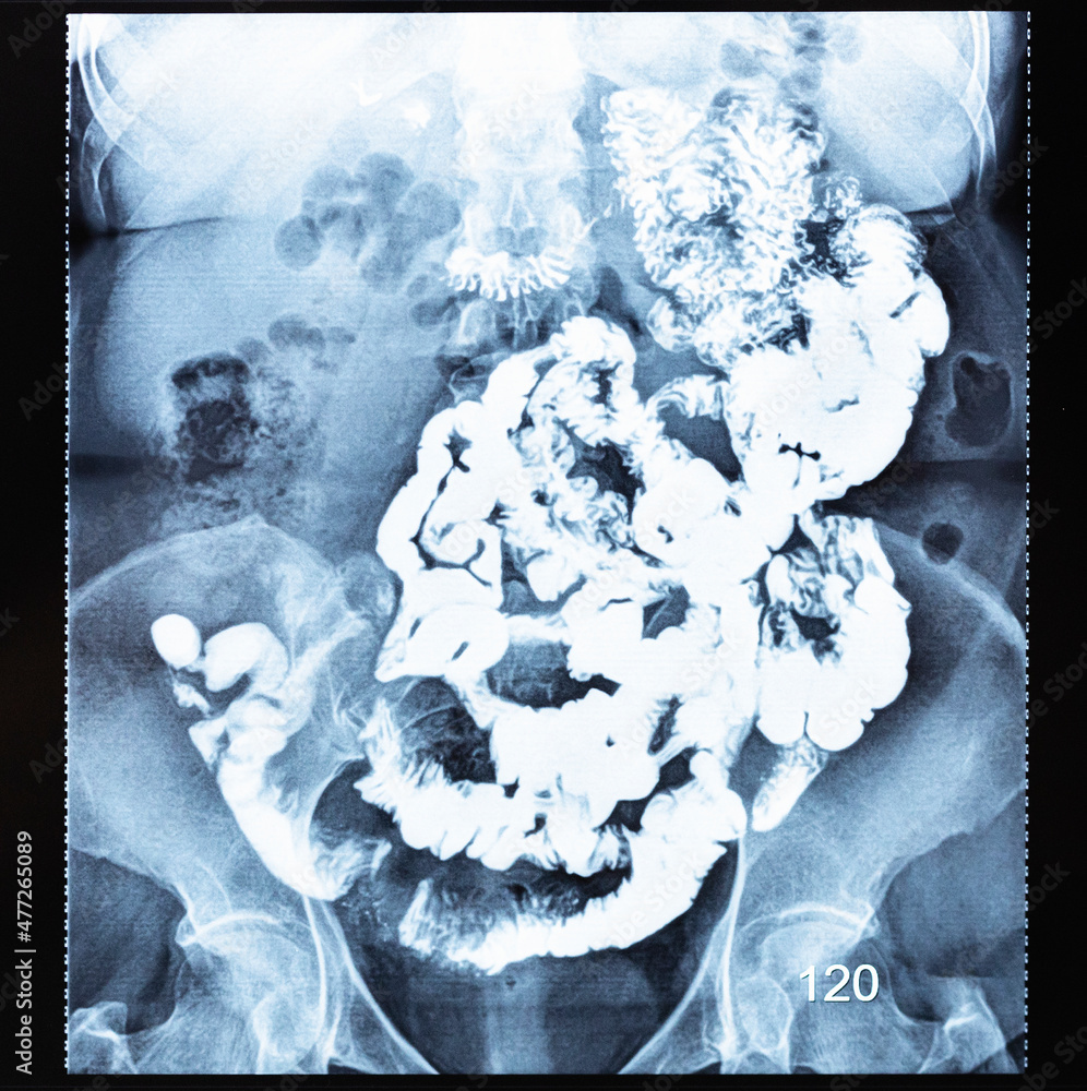 X-ray radiogram with Barium study of small bowel after 120 minutes (two ...
