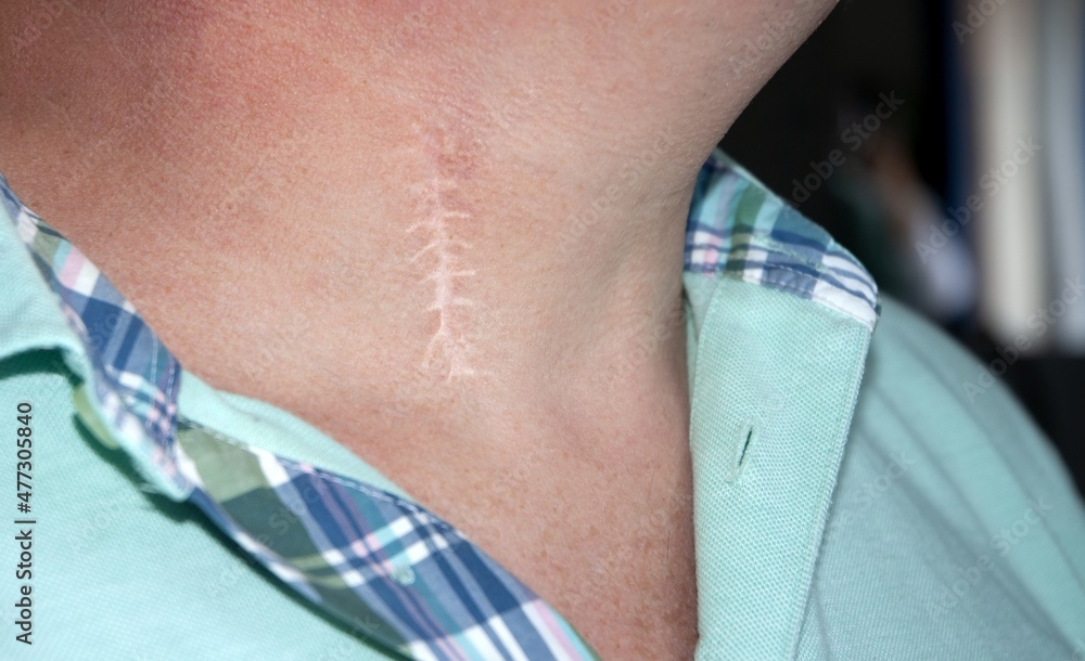 Scar left on the neck after a surgical intervention of a cervical disc ...