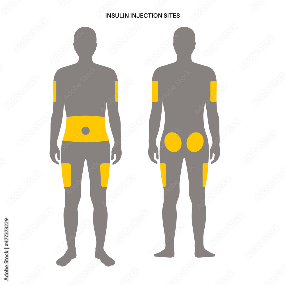 Insulin injection sites Stock Vector | Adobe Stock