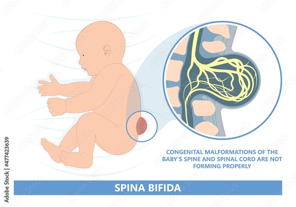 Vettoriale Stock Spina Bifida Pregnancy Non Invasive Neural Tube Gene
