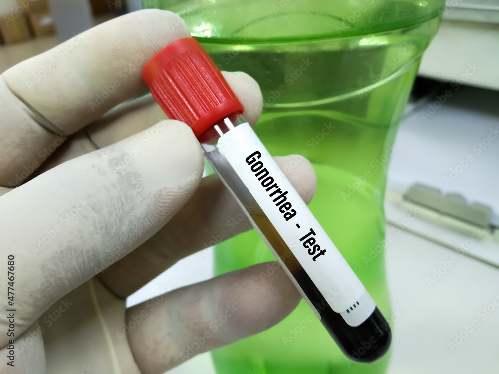 Blood sample for Venereal disease research laboratory (VDRL) test at ...