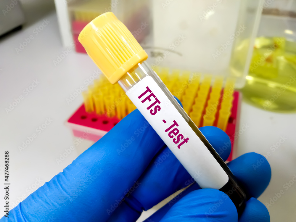 Blood Sample For Thyroid Function Tests TFTs At Medical Laboratory Blood Sample For Thyroid Function Tests TFTs At Medical Laboratory